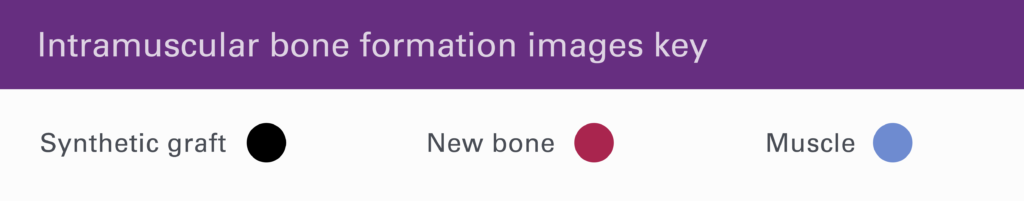 AttraX® EU - NuVasive