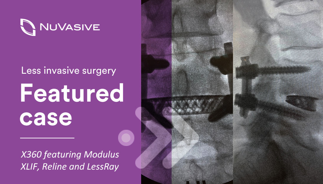Featured Case: X360 featuring Modulus XLIF, Reline and LessRay - NuVasive
