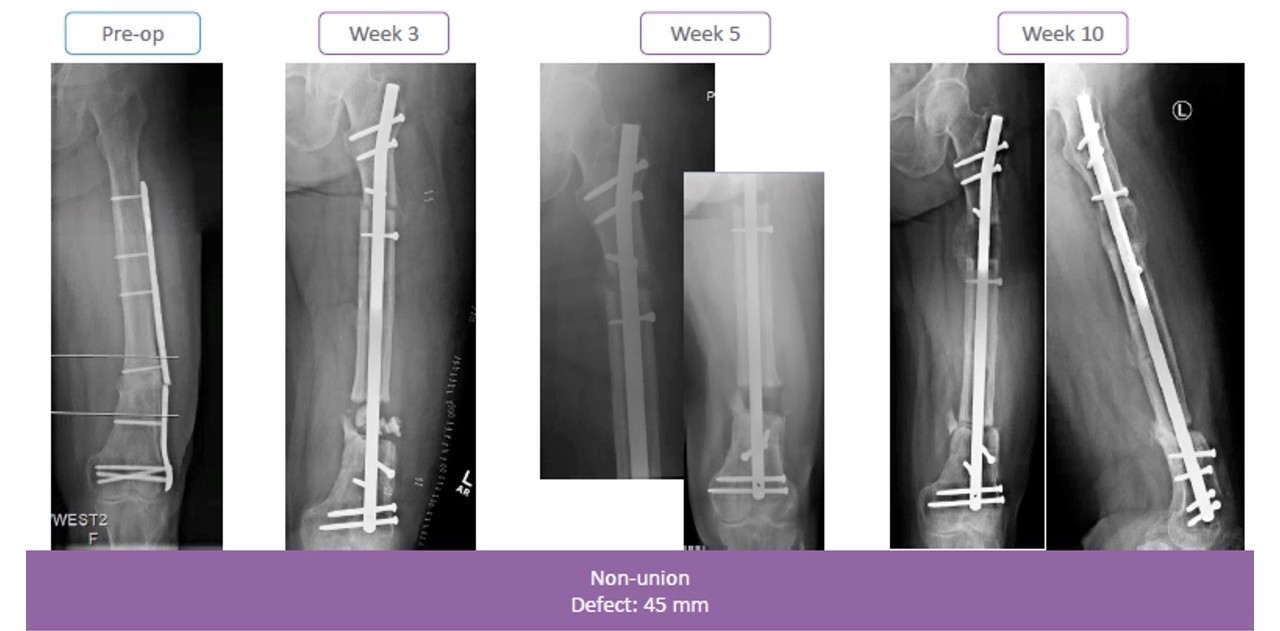 NSO Germany | Precice Bone Transport system - NuVasive