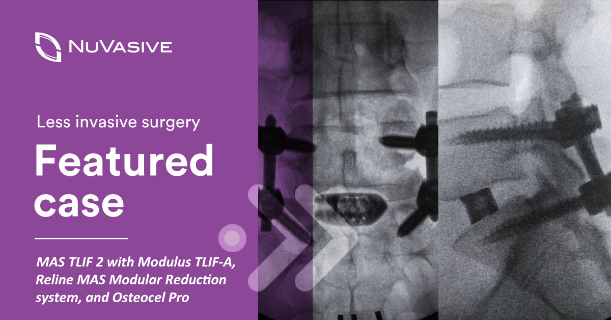 Featured Case: MAS TLIF 2 with Modulus TLIF-A - NuVasive