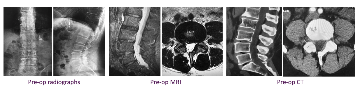 Featured Case: Prone single-position surgery with XLIF Prone and MAS ...