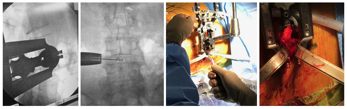 Featured Case: Prone single-position surgery with XLIF Prone and MAS ...