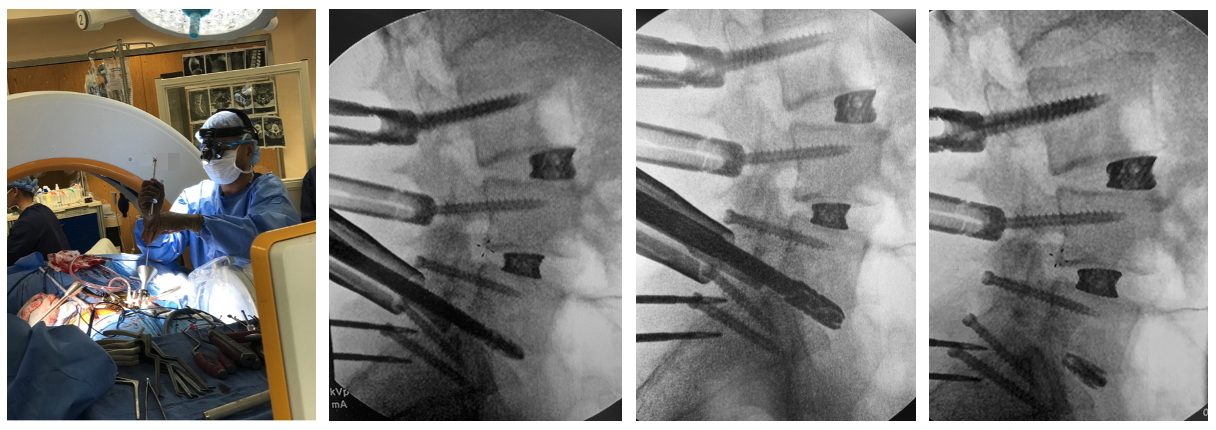 Featured Case: Prone single-position surgery with XLIF Prone and MAS ...